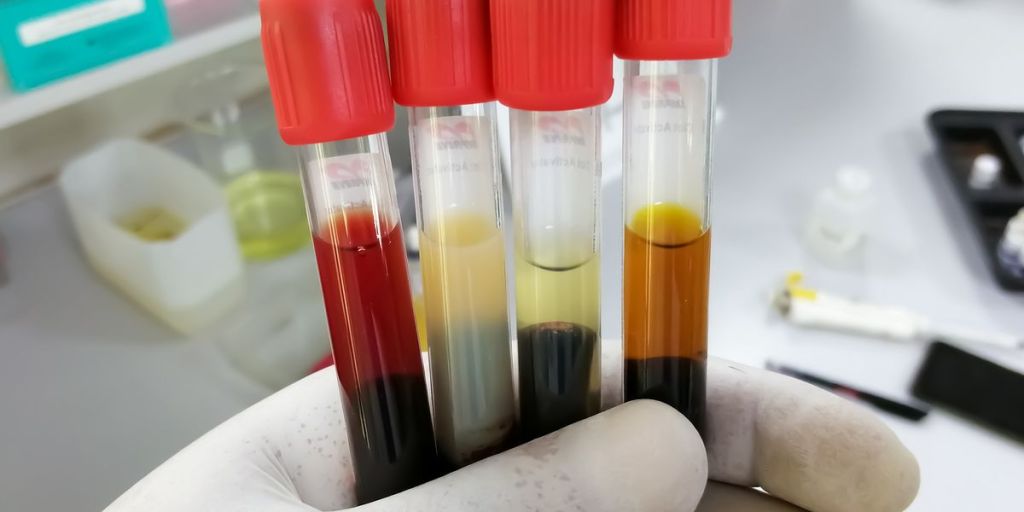 The Effects of Hemolysis, Lipemia, and Icterus on Laboratory Test ...