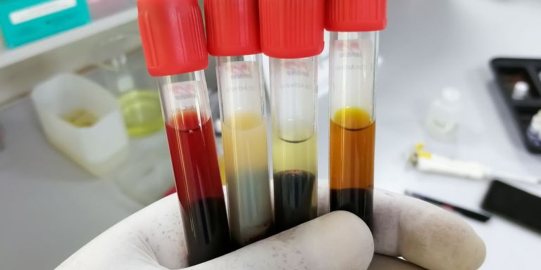 The Effects of Hemolysis, Lipemia, and Icterus on Laboratory Test ...